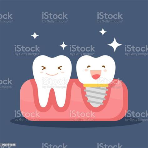 치과 임 플 란 트 하 고 정상적인 치아입니다 구강에 복원입니다 치과의 주제에 평면 그림입니다 벡터 일러스트 파란색 배경에 고립입니다 치아 임플란트에 대한 스톡 벡터 아트