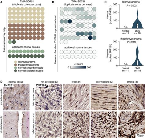 A The Structure Of Tma Of Soft Tissue Cancer So751a Us Biomax Download Scientific Diagram
