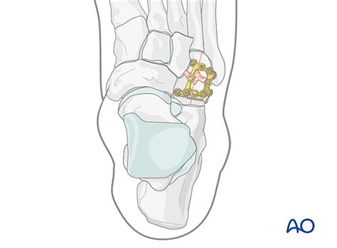 Plate Fixation For Multifragmentary Cuboid Fracture