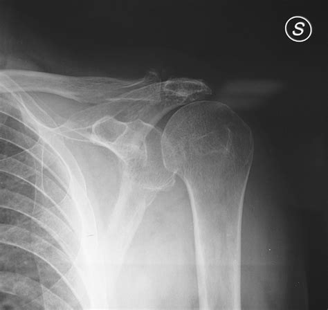 Preoperative X Ray Of A Left Shoulder Showing A Hamada Type Iii Cta A