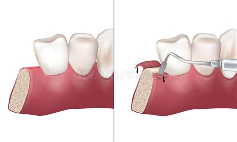 Flap Incision Stock Illustrations 13 Flap Incision Stock