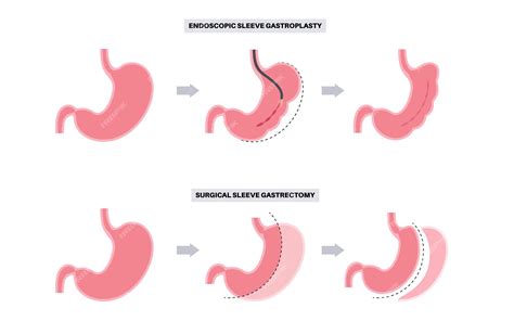 Premium Vector Endoscopic Sleeve Gastroplasty And Gastrectomy Operation Stomach Surgery Weight