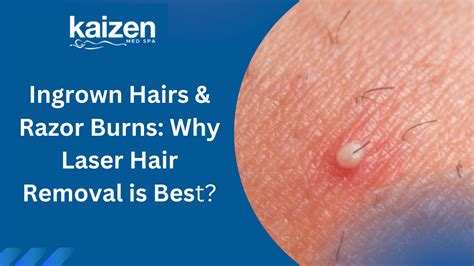 Goodbye To Ingrown Hairs Benefits Of Laser Hair Removal