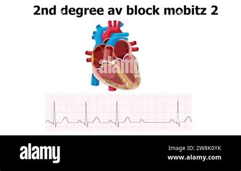 Ecg Shows 2d Degree Av Block Mobitz 2 With Heart Animation Stock Video