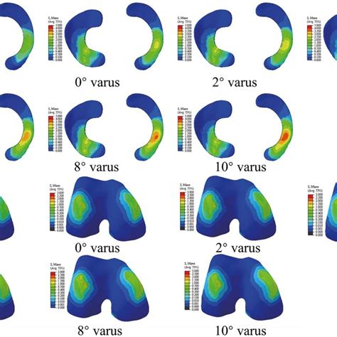 The Peak Vms Stress Distribution Of Meniscus And Femoral Cartilage Of Download Scientific