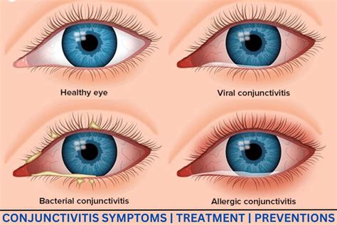 Conjunctivitis Outbreak In Telangana Cases Reported Statewide