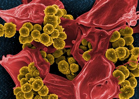 May 19 Genetic Condition Causes Severe Staphylococcus Aureus
