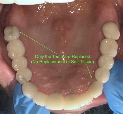 Full Arch Fp 1 Fixed Zirconia Bridge Prosthesis With 10 Implants In The Upper Arch Case 4124