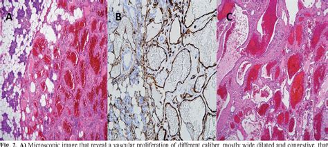 Figure 2 From Cavernous Hemangioma Of The Parotid Gland In Adults Semantic Scholar
