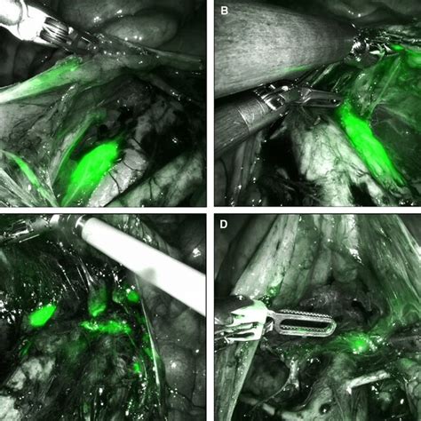Lower And Upper Para Aortic Sentinel Lymph Nodes Slns A Secondary