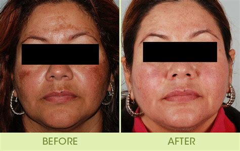 Vi Peel Boston Plastic Surgery