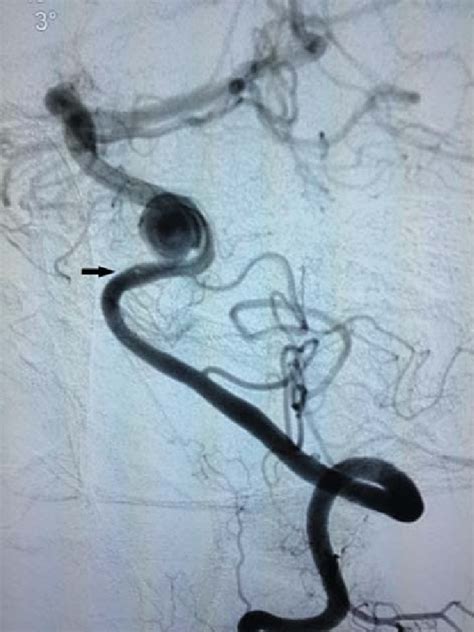 Selective Angiography Of The Left Vertebral Artery Side Position Download Scientific Diagram
