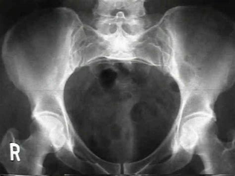 Pelvic Inlet Radiology Vascular Anatomy Of The Pelvis Rgnc