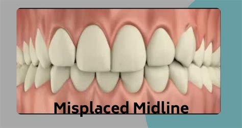 Having Misplaced Midline The Problems It Could Cause And The