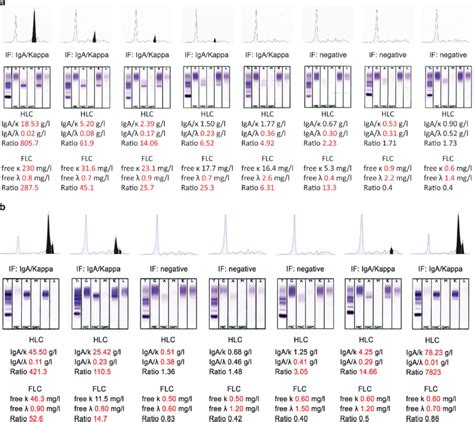Sequential Spep Ife Hlc Ratios And Flc Ratios In Two Patients With Download Scientific