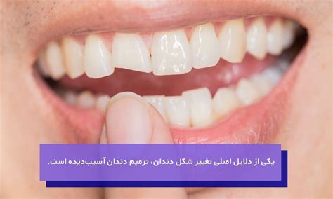 تراش دندان؛ چرا در لمینت، دندان را می‌تراشند دندانپزشکی شبانه روزی تاج