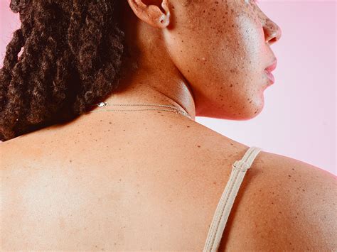 Hyperpigmentation On Back