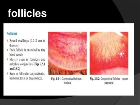 Difference Between Follicles And Papillae Difference Between Follicles And Papillae