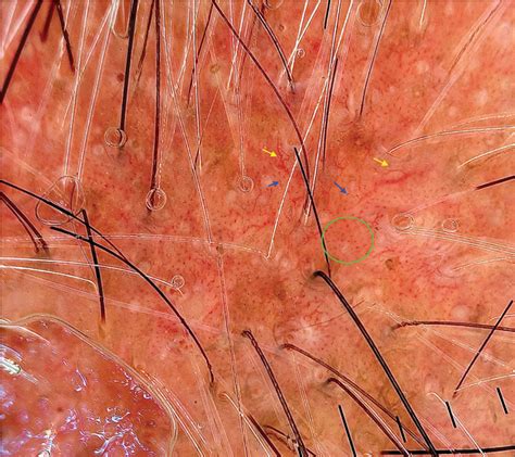 Role Of Dermoscopy In Differentiating Seborrheic Dermatitis Of Scalp
