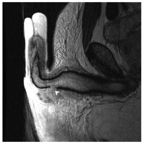 The Role Of Magnetic Resonance Imaging In Penile Fracture Management—a