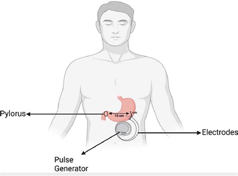Positioning Of Gastric Pacemaker In Relation To The Greater Curvature Download Scientific