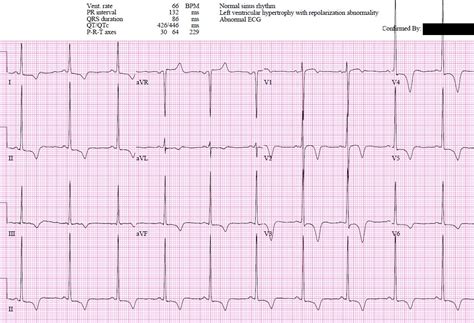 St Segment Elevation Ecg