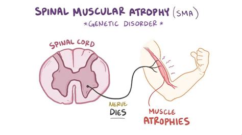 Video Spinal Muscular Atrophy Osmosis