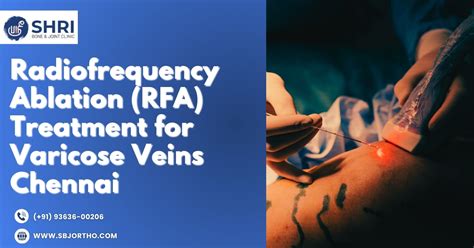 Radio Frequency Ablation Rfa Treatment For Varicose Veins
