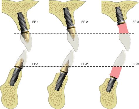 Treatment Planning Complications Pocket Dentistry