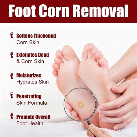 Extra Strength Foot Corn Removal Gel 10ml Skin Smoothing And Repairing
