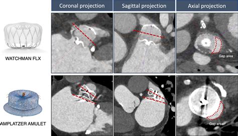 Cardiac Ct Multiplanar Reconstructed Views For Investigation Of