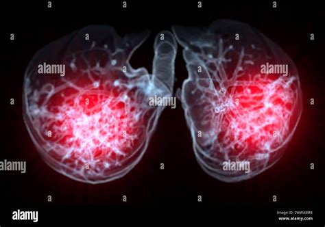 Ct Chest Or Lung 3d Rendering Image Showing Trachea And Lung In