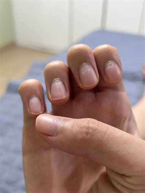 손톱 울퉁불퉁 지식in