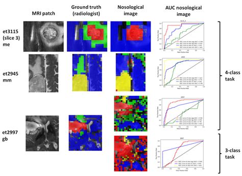 three example cases rows cases columns mri patch or mri that
