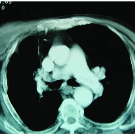 A Chest Ct Of Patient 2 A Lesion Misdiagnosed As A Soft Tissue Abscess