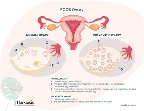 Polyendocrine Metabolic Ovarian Syndrome Pmos Formerly Pcos