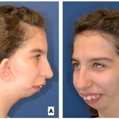 Patient 5 Years Old With Hf Pruzansky Iii A Three Quarter View Soft Download Scientific