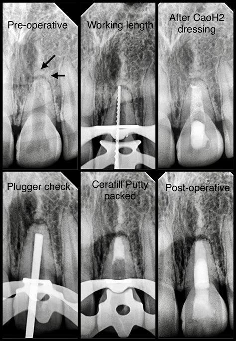 Maxillary Central Incisor With Wide Open Apex And Apical Root