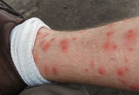 An Introduction To Chiggers The Infinite Spider
