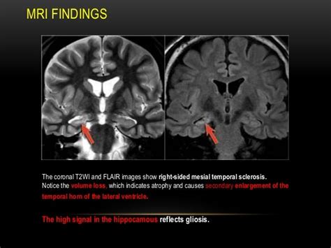 Mesial Temporal Lobe Epilepsy