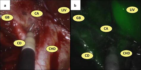 Robotic Cholecystectomy Anesthesia Key