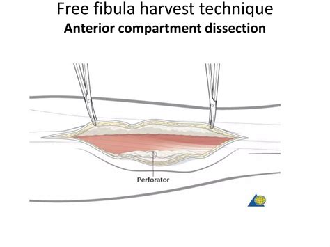 Free Fibula Flap Technique Pptx