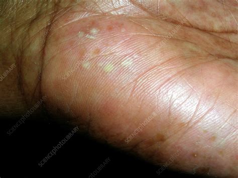 Palmoplantar Pustulosis Stock Image C056 2593 Science Photo Library