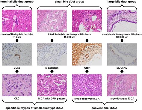 Expert Consensus On Pathological Diagnosis Of Intrahepatic Cholangiocarcinoma 2022 Version Expert Consensus On Pathological Diagnosis Of Intrahepatic Cholangiocarcinoma 2022 Version