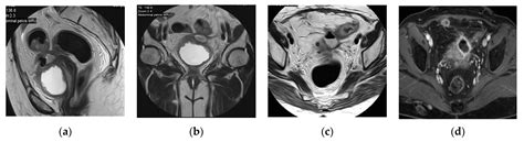 Ct And Mri In Urinary Tract Infections A Spectrum Of Different Imaging