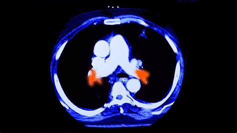 Positive Data On Lytic Avoiding Pe Thrombectomy Catheter Trendradars