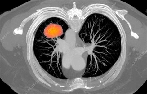 What Do Lung Nodules Look Like On Ct Scan Ct Scan Machine