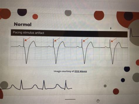 Pacemaker Flashcards Quizlet