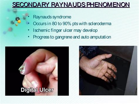 Auto Immune Vasculopathy And Scleroderma Ayurvedic Perspective Ppt
