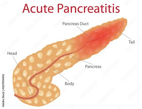 Labeled Medical Diagram Of Acute Pancreatitis Showing Inflamed Pancreas